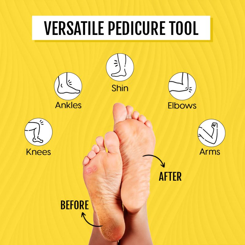 Matra Pumice Stone with Rubber Grip Pedicure Tool for Foot Scrubbing ...
